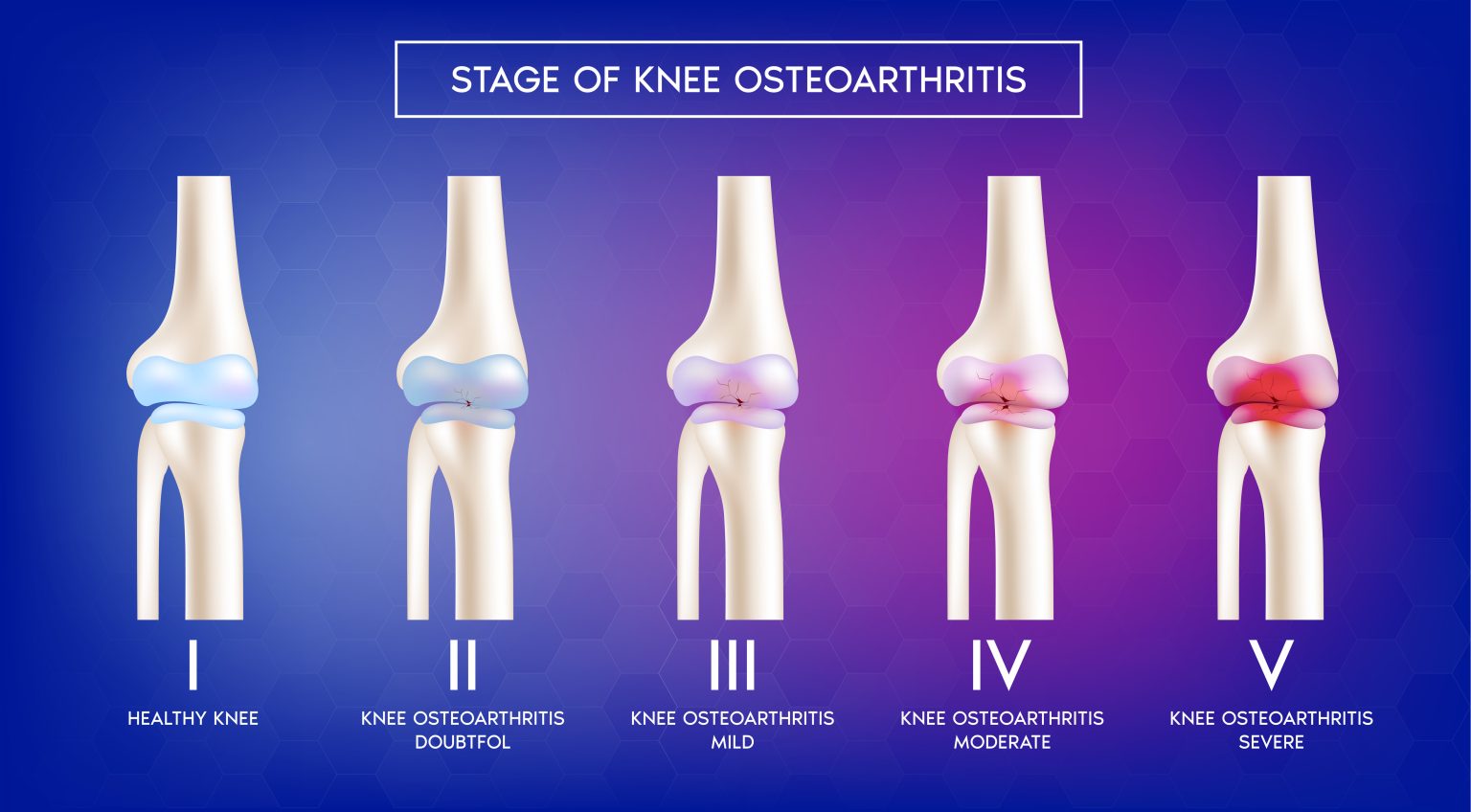 Knee Osteoarthritis - GulfPhysio - UAE's Online Physiotherapy Store