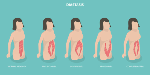 Diastasis Recti: Causes, Symptoms, And Treatment - GulfPhysio - UAE's ...