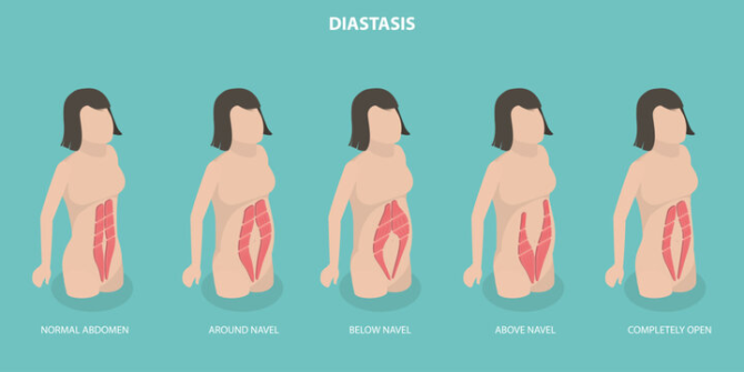 Diastasis Recti: Causes, Symptoms, And Treatment - GulfPhysio - UAE's ...